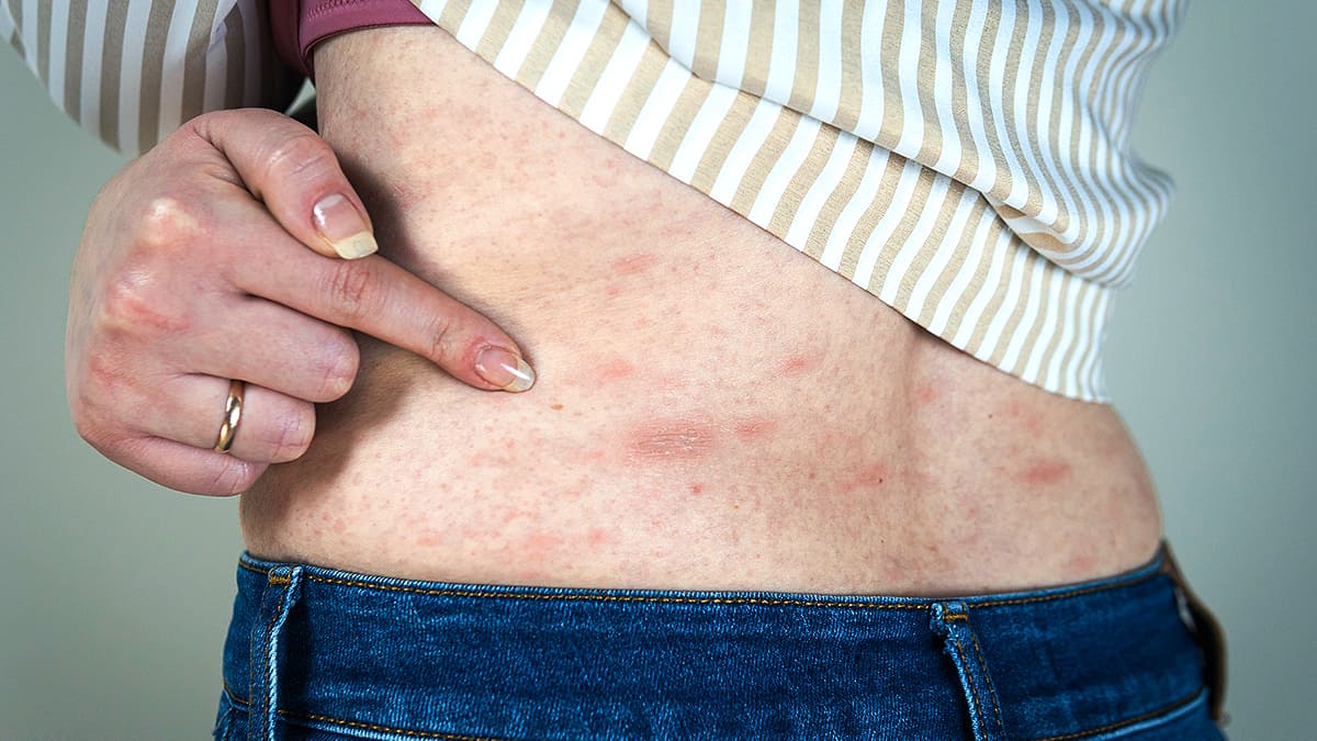Chronic skin rashes that itch - nationlopers Chronic skin rashes that itch - nationlopers